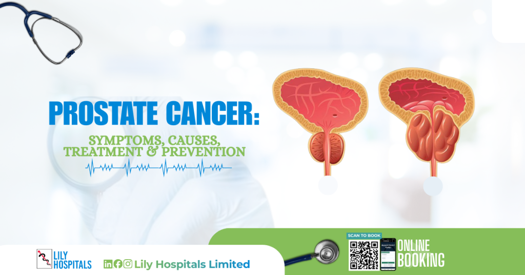 Prostate Cancer: Symptoms, Causes, Treatment & Prevention - Lily Hospitals